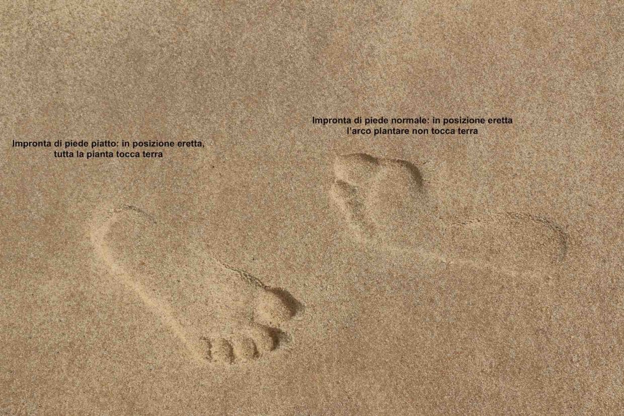 Piede piatto del bambino: cos'è, come si manifesta, cosa si può fare ...